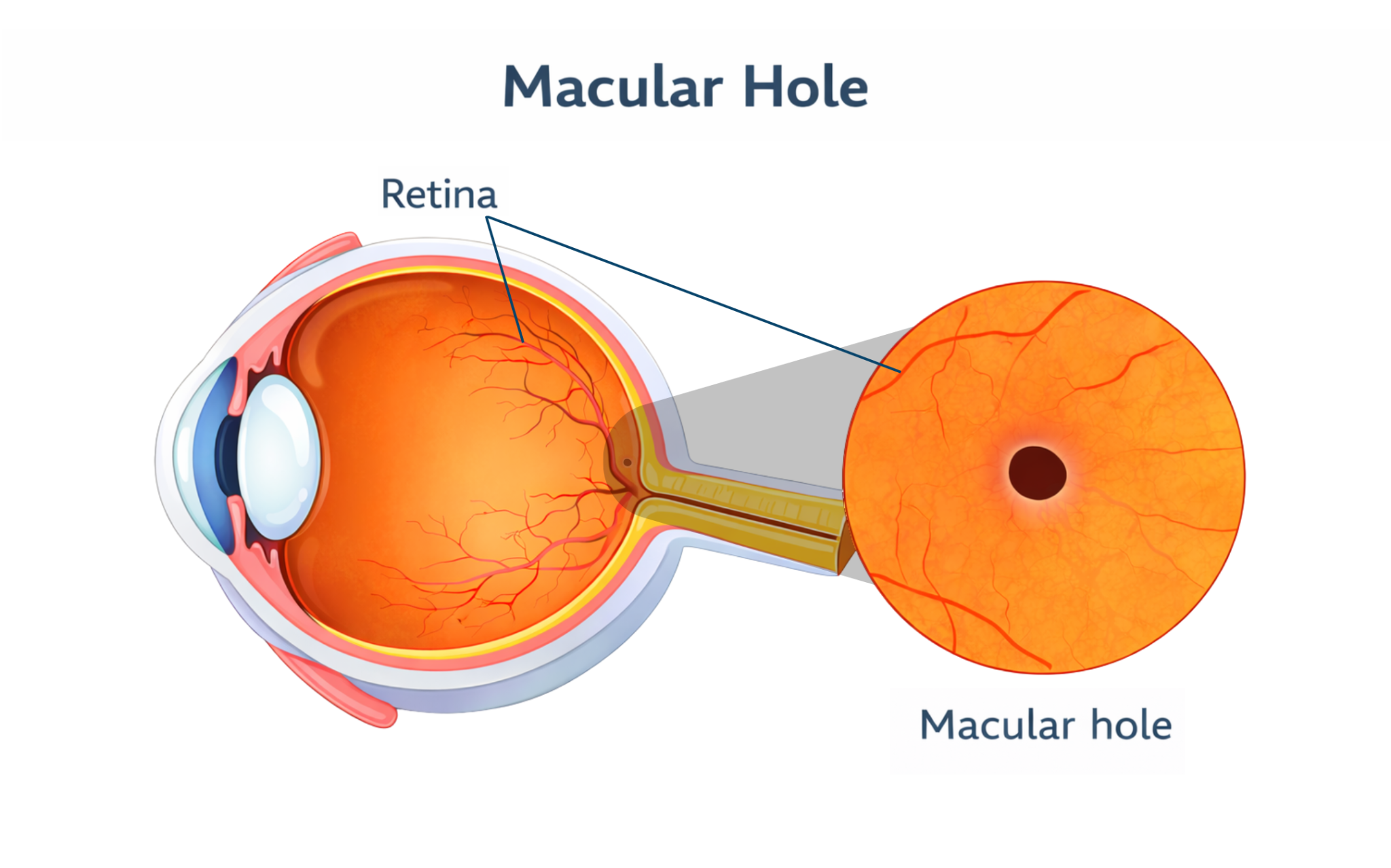 Surgery for Macular Holes & Epiretinal Membranes in Singapore - Dr ...