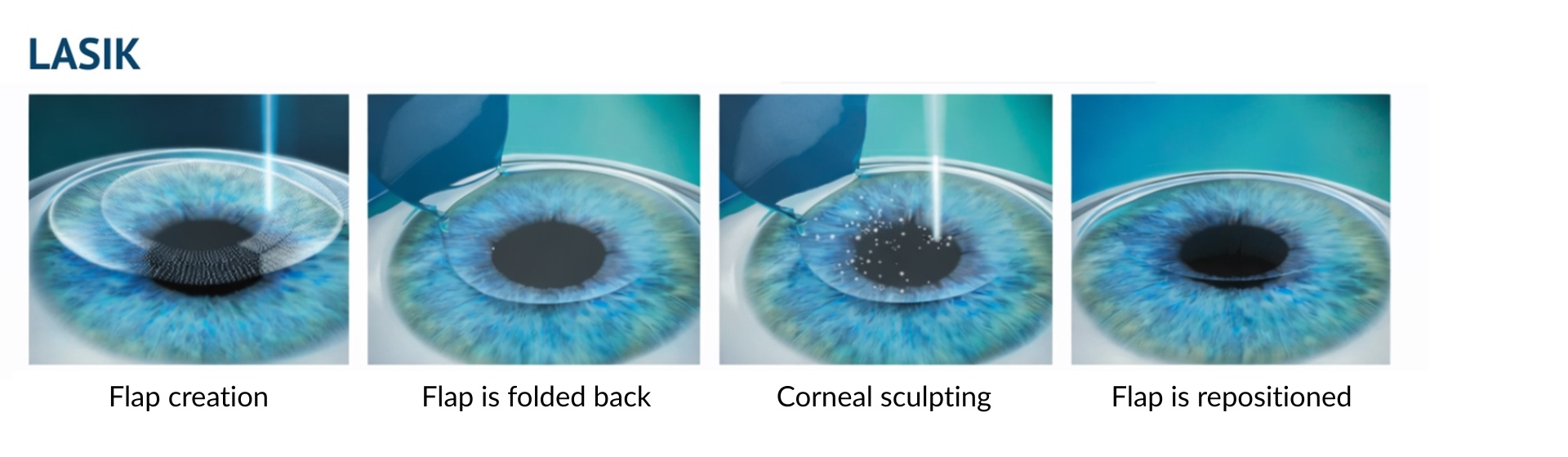 ICL Vision Correction: A Solution Beyond LASIK | Ascend Eye Clinic ...