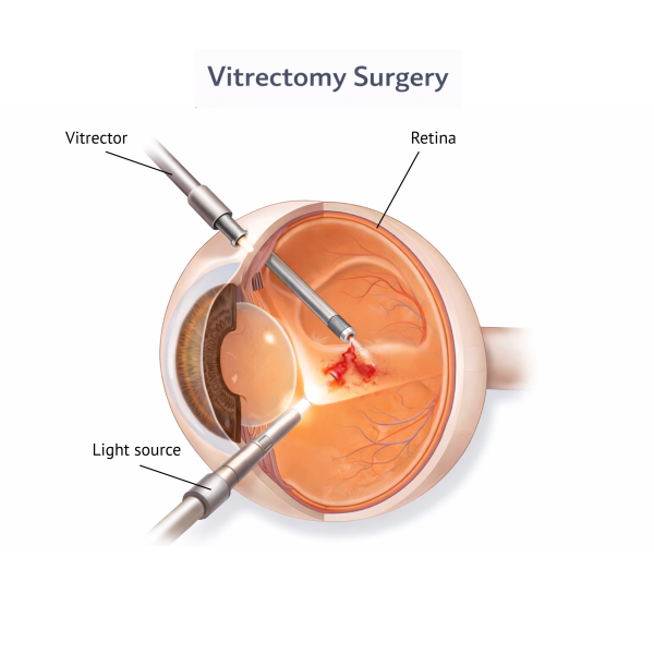 Surgery for Macular Holes & Epiretinal Membranes in Singapore - Dr ...